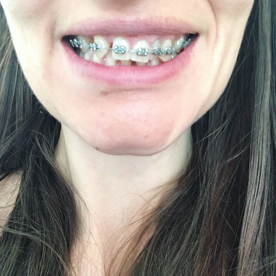 Adult Braces Progress: My Month by Month Journey & Photos