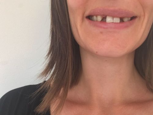 Braces at 30 | Peg tooth extraction | 28 Months