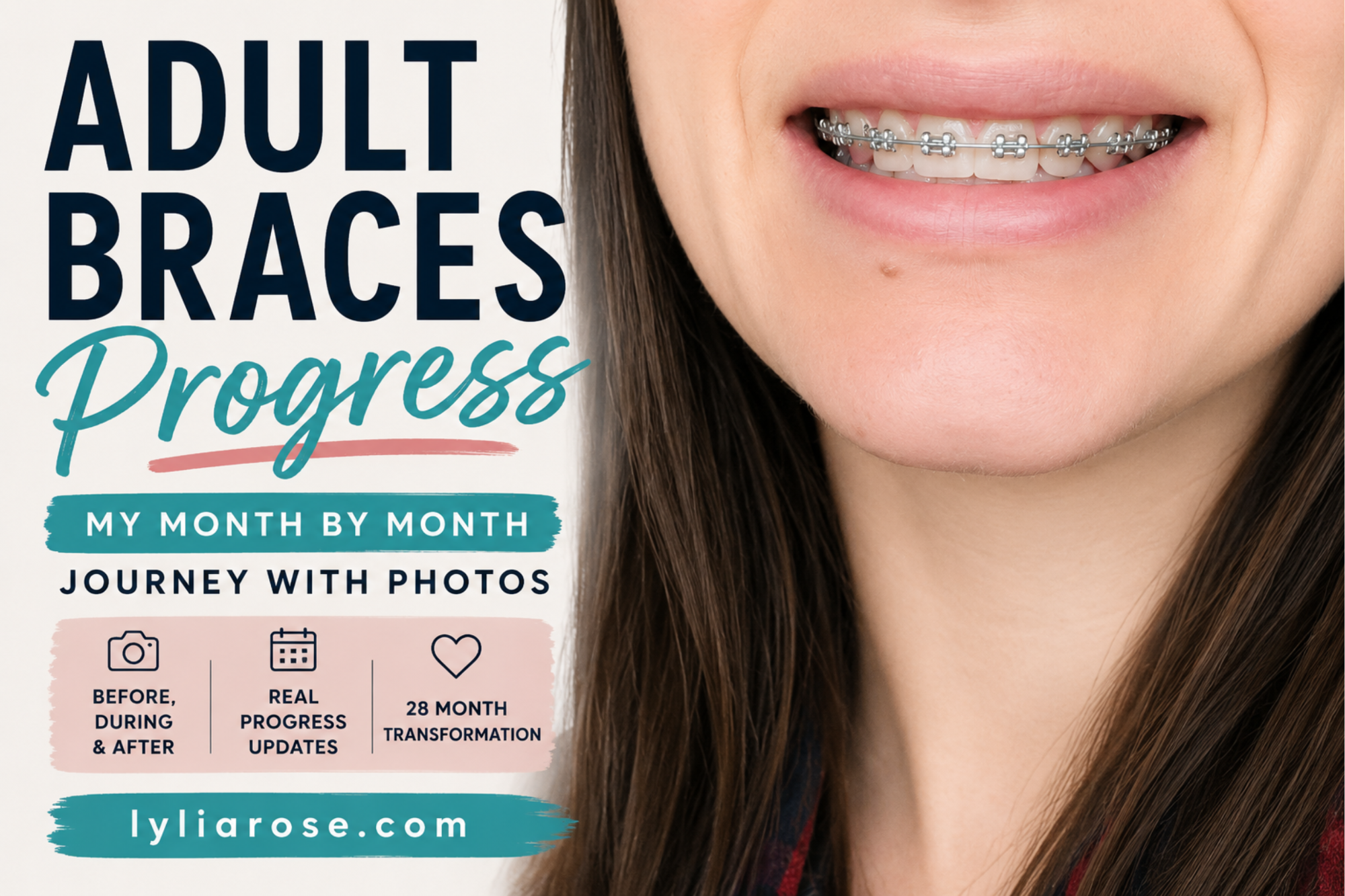 Adult Braces Progress: My Month by Month Journey & Photos